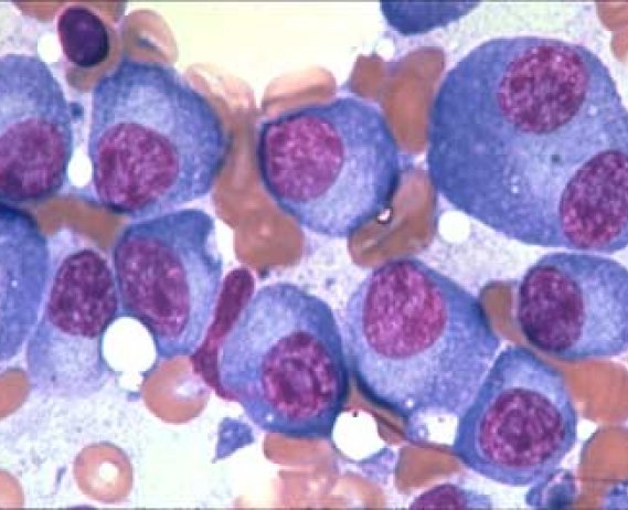 Single Cell Studies Lead to MM Cure? | Int Myeloma Fn