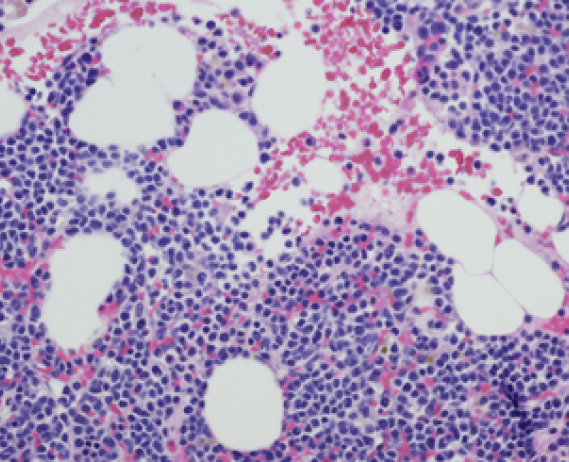 EHA-EMN Recommend Pepaxti for RRMM | Int'l Myeloma Foundation